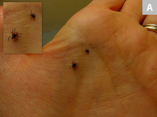 Image Gallery: Ticks of the Northeastern United States | Clinician's Brief