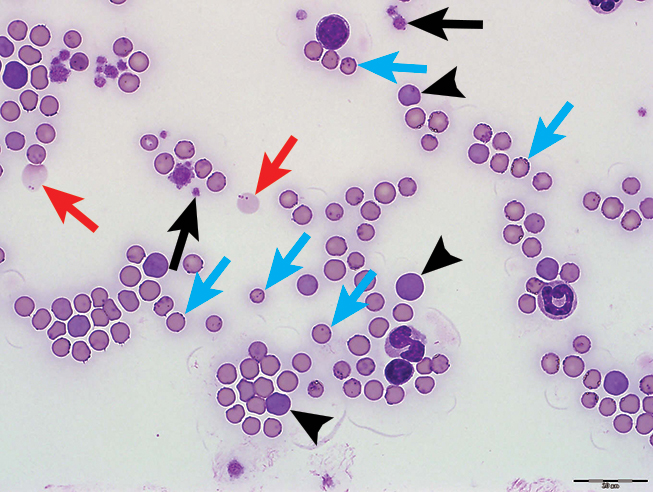 Image Gallery: Red Blood Cell Evaluation in Blood Films | Clinician's Brief