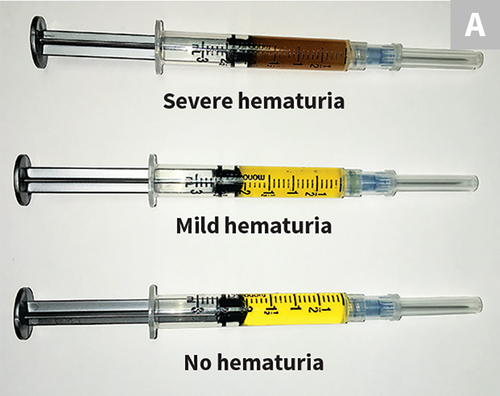 Cyclophosphamide-Induced Sterile Hemorrhagic Cystitis | Clinician's Brief