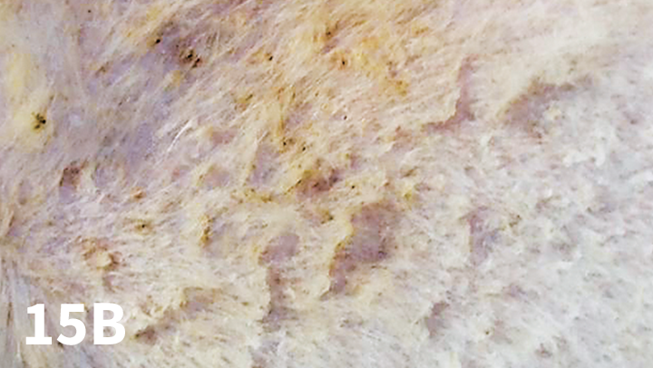 10 Dermatoses to Consider in the Young Patient | Clinician's Brief
