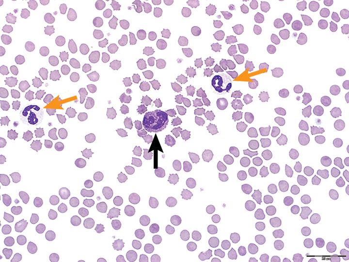 Quiz: White Blood Cell Evaluation in Blood Films | Clinician's Brief