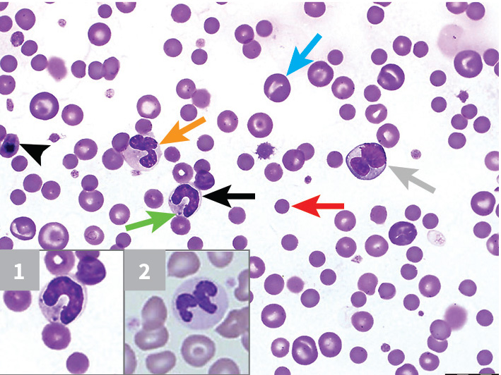 Quiz: White Blood Cell Evaluation in Blood Films | Clinician's Brief
