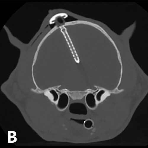 Congenital Hydrocephalus | Clinician's Brief