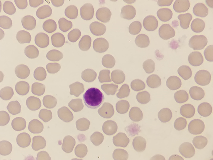 Image Quiz: Identifying Cells in Peripheral Blood | Clinician's Brief