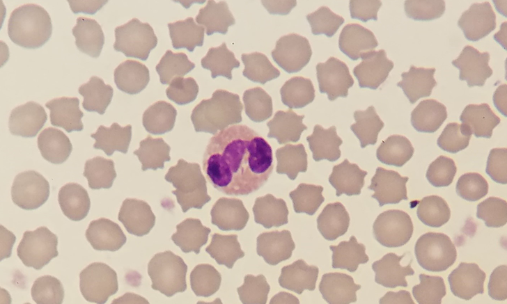 Image Quiz: Identifying Cells in Peripheral Blood | Clinician's Brief