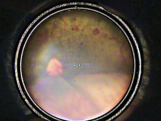 Performing Direct Ophthalmoscopy | Clinician's Brief