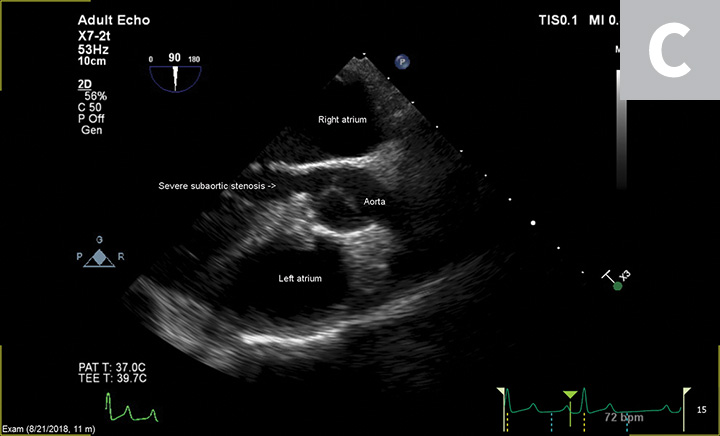 Subclinical Subaortic Stenosis in a Golden Retriever | Clinician's Brief