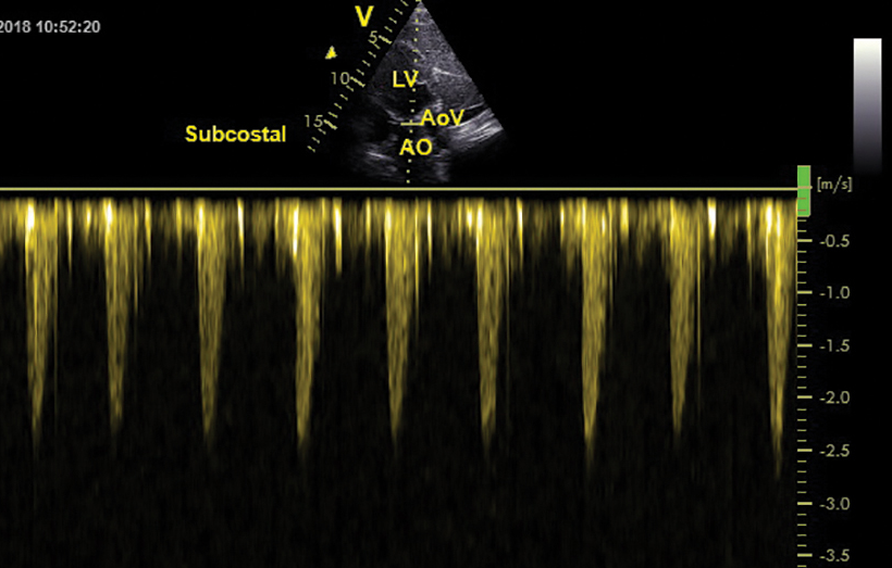 Subclinical Subaortic Stenosis in a Golden Retriever | Clinician's Brief