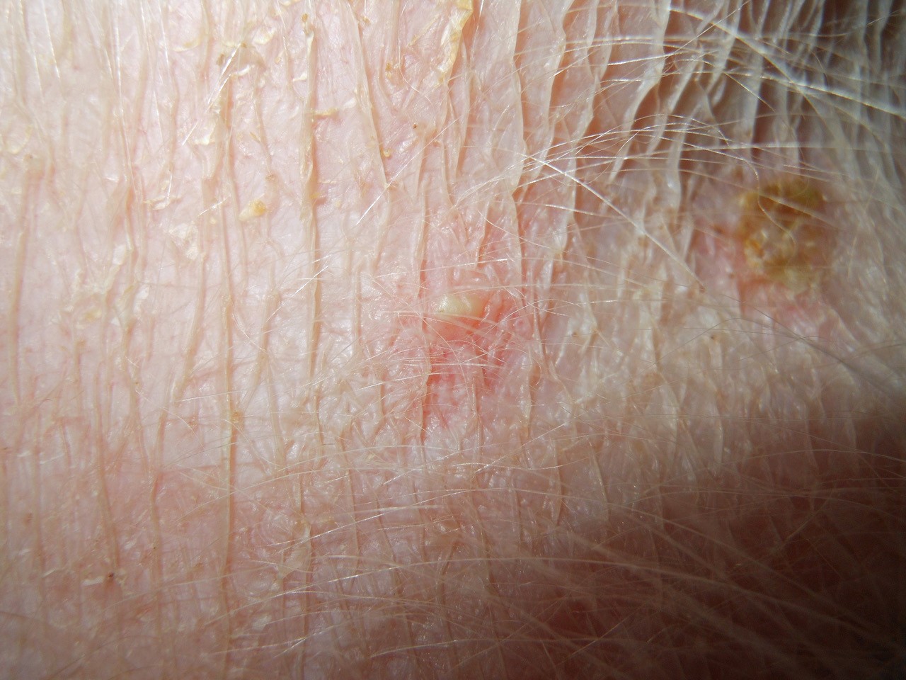 Image Gallery: Primary Skin Lesions | Clinician's Brief