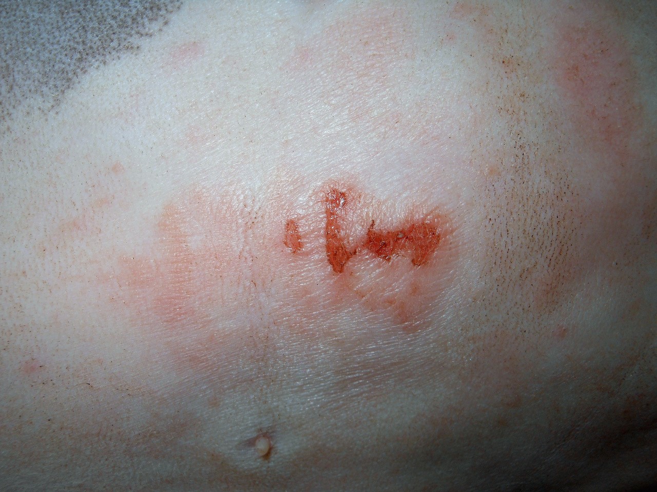 Image Gallery: Secondary Skin Lesions | Clinician's Brief