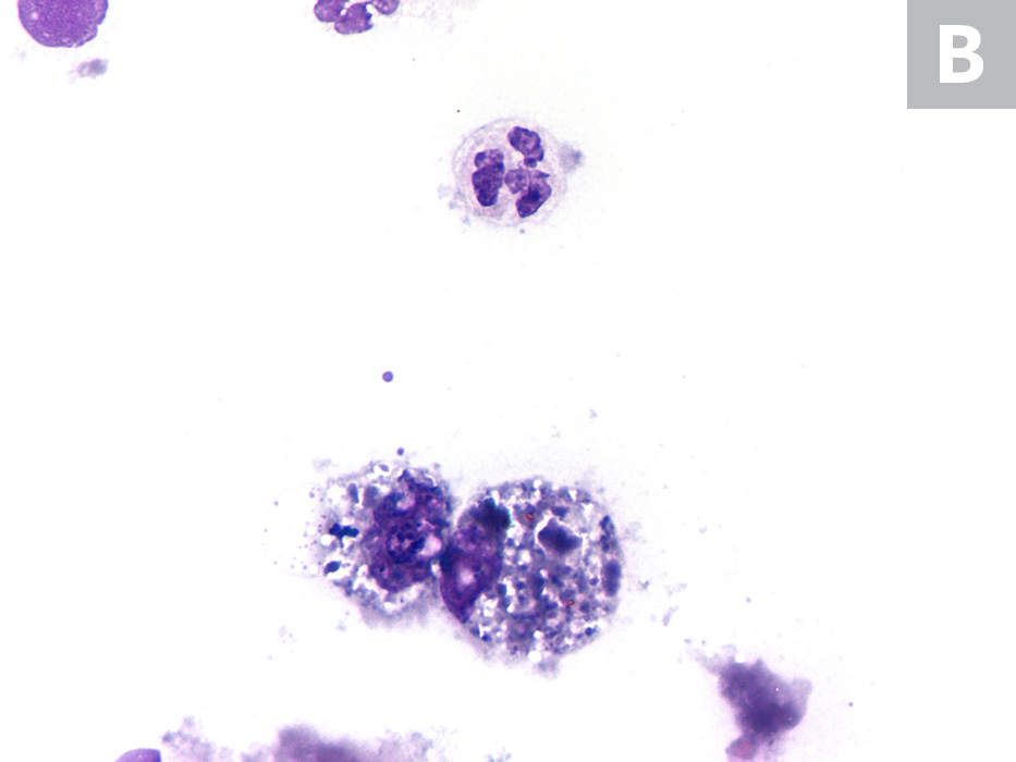 Effusion Cytology | Clinician's Brief