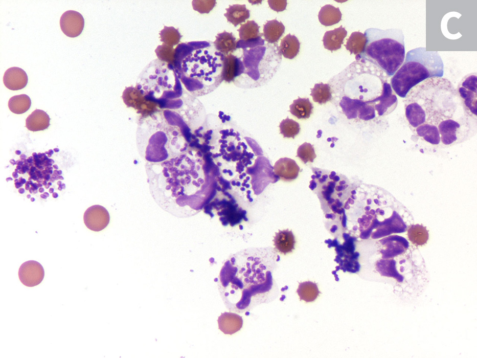 Effusion Cytology | Clinician's Brief