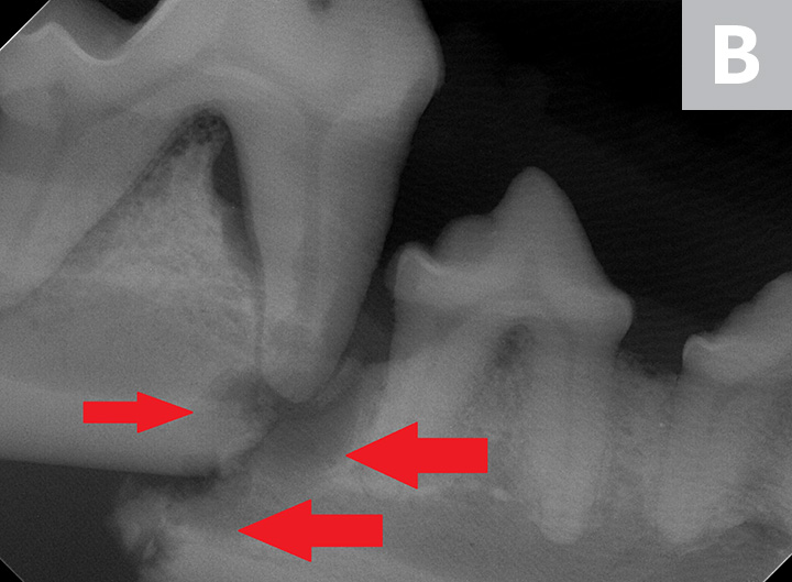 Bilateral Iatrogenic Mandibular Fracture | Clinician's Brief