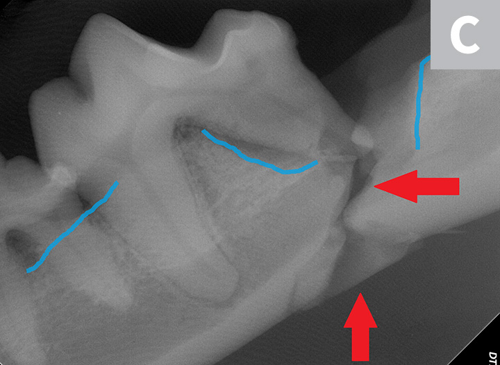 Bilateral Iatrogenic Mandibular Fracture | Clinician's Brief