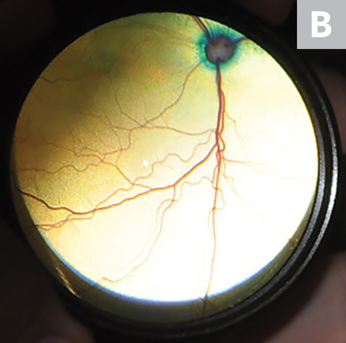 Fundic Examination | Clinician's Brief