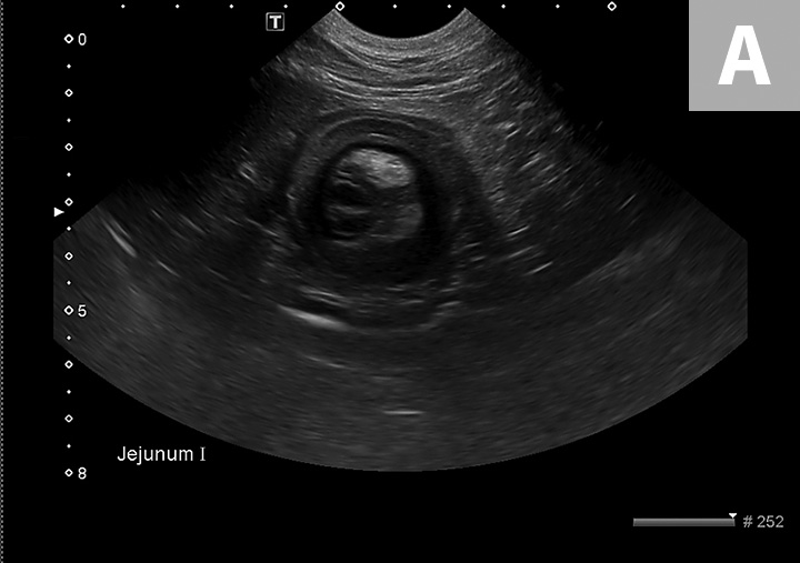 Intussusception Reduction | Clinician's Brief