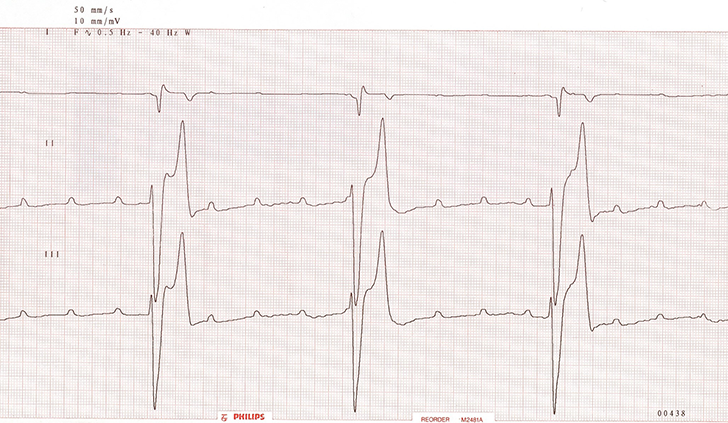 Quiz: Identify the Arrhythmia | Clinician's Brief