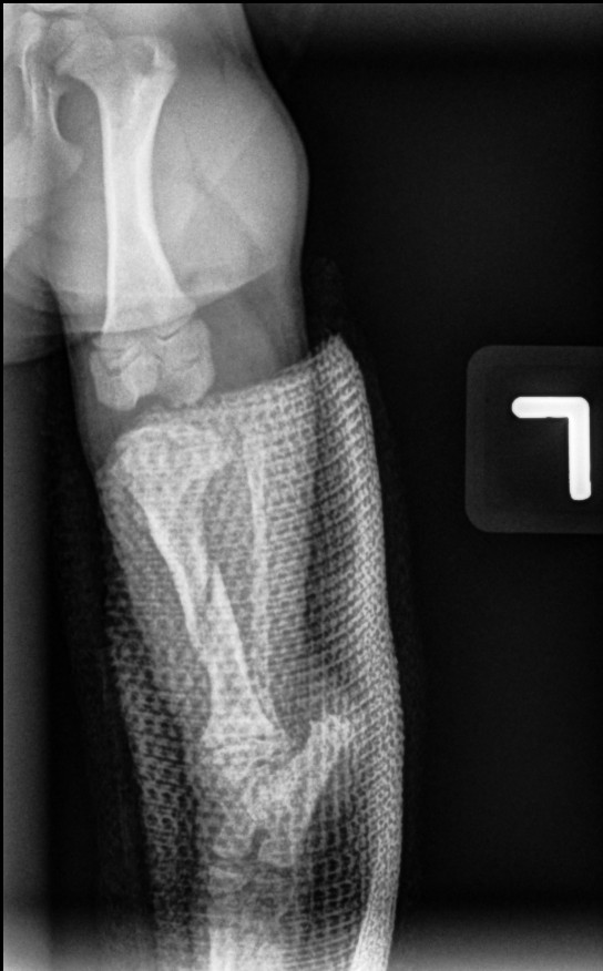 Quiz: External Coaptation vs Surgical Fixation for Bone Fractures ...
