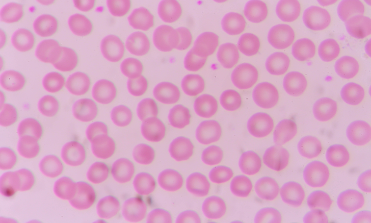 Differential Diagnosis: Thrombocytosis | Clinician's Brief