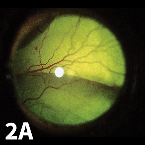 Retinal Detachment | Clinician's Brief