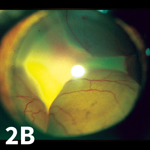 Retinal Detachment | Clinician's Brief