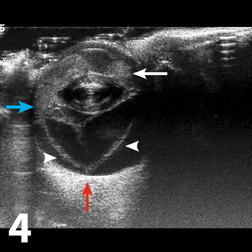 Retinal Detachment | Clinician's Brief