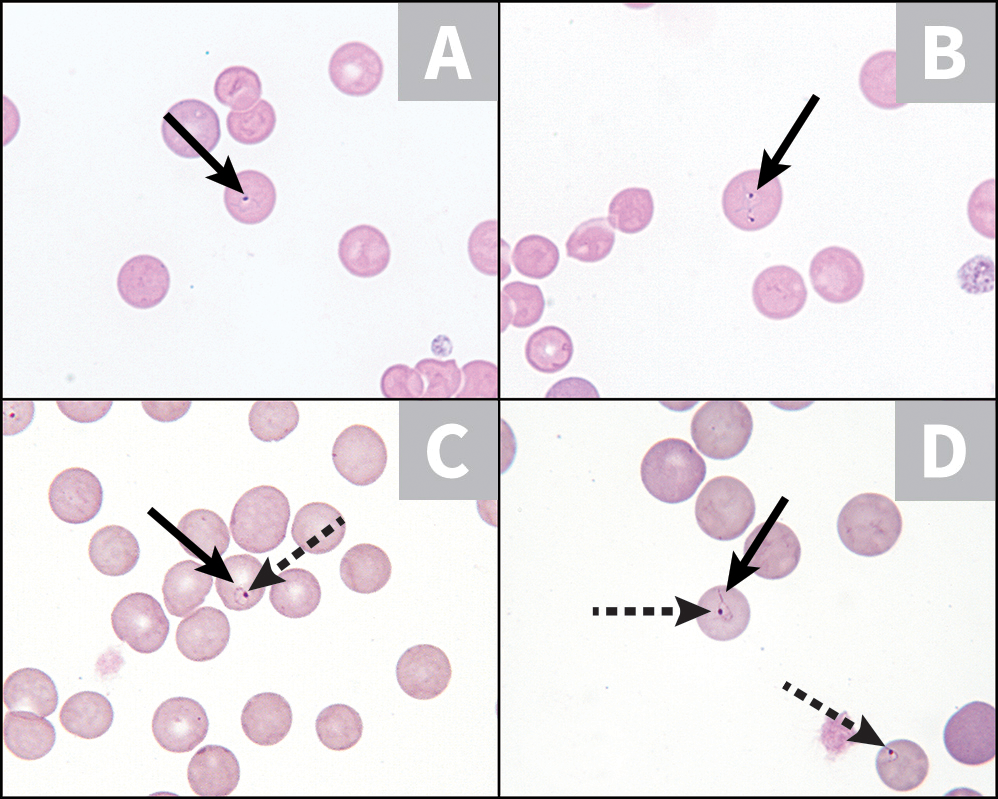 Babesiosis | Clinician's Brief