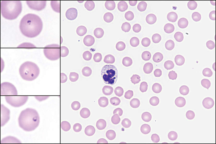 Babesiosis | Clinician's Brief