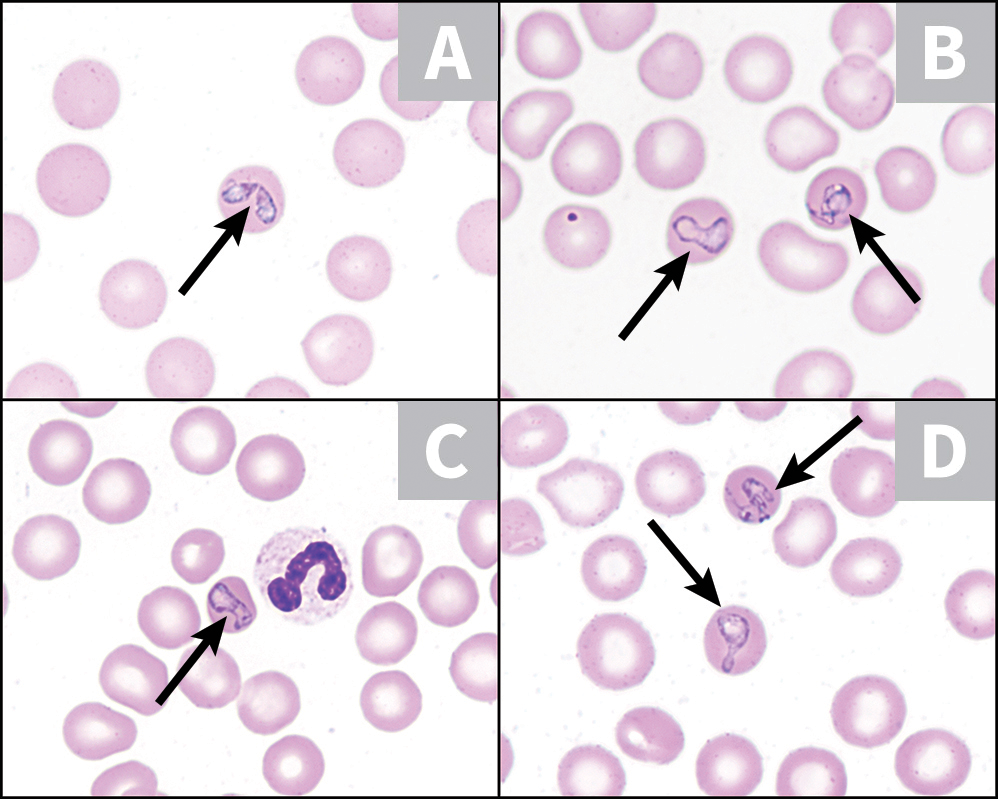 Babesiosis | Clinician's Brief