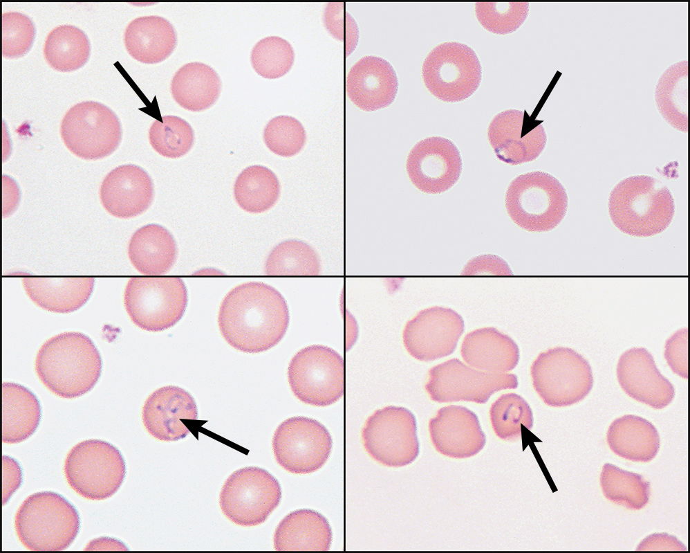 Babesiosis | Clinician's Brief