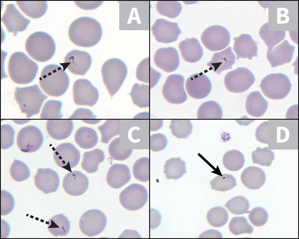 Babesiosis | Clinician's Brief