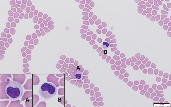 Degenerative Left Shift Cbc Report Articleeducationx