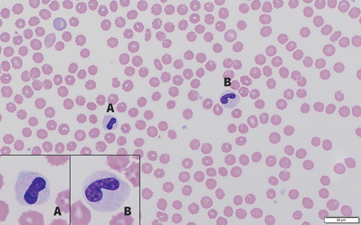 Degenerative Left Shift Cbc Report Articleeducationx