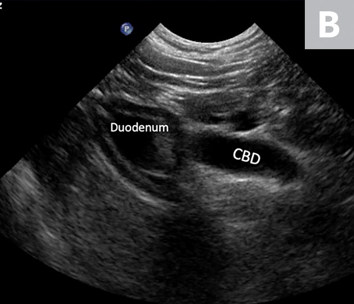 Hepatobiliary Imaging with Radiography & Ultrasonography: Biliary ...