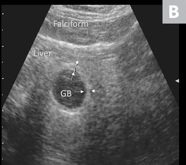 Hepatobiliary Imaging with Radiography & Ultrasonography: Biliary ...