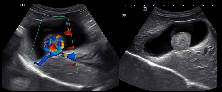 Hepatobiliary Imaging with Radiography & Ultrasonography: Biliary ...