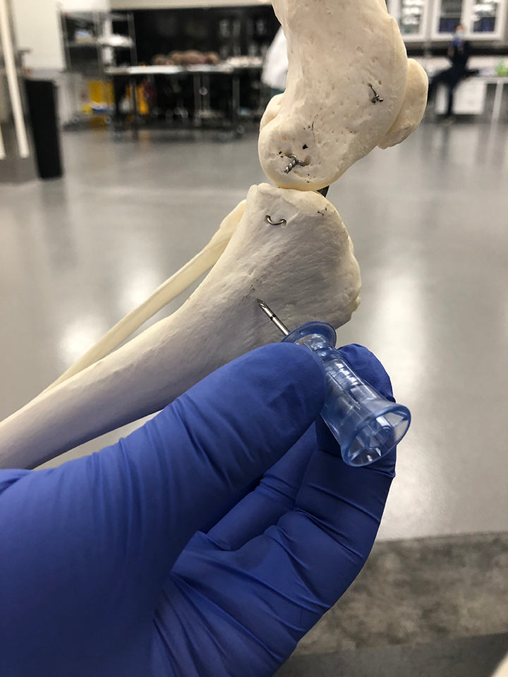 Alternative Methods for IV Access | Clinician's Brief