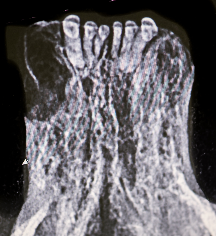 Crown Amputation for Tooth Resorption | Clinician's Brief