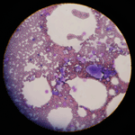 How to Collect Bone Marrow Samples | Clinician's Brief