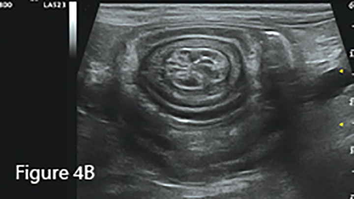 Imaging Intestinal Obstruction | Clinician's Brief