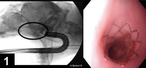 Interventional Endoscopy: The Essentials | Clinician's Brief