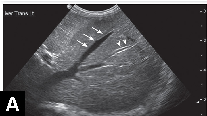 Liver Ultrasound-Guided Fine-Needle Aspiration | Clinician's Brief