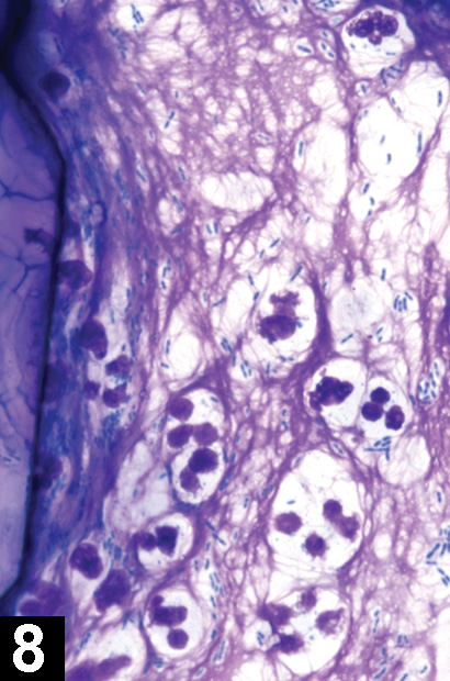 Struvite Crystalluria: Three Cases | Clinician's Brief