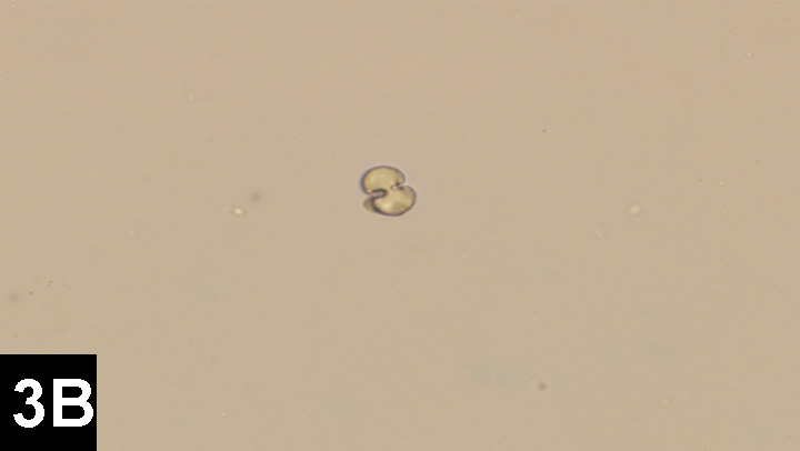 Calcium Oxalate Urolithiasis | Clinician's Brief