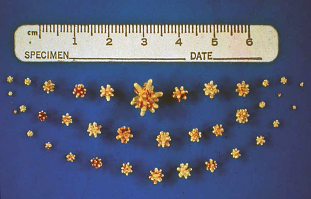 Silica Urolithiasis | Clinician's Brief