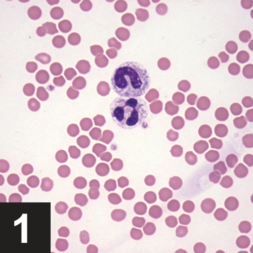 Top 5 Leukogram Patterns | Clinician's Brief