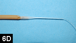 Percutaneous Endoscopic Gastrostomy Tube Placement | Clinician's Brief