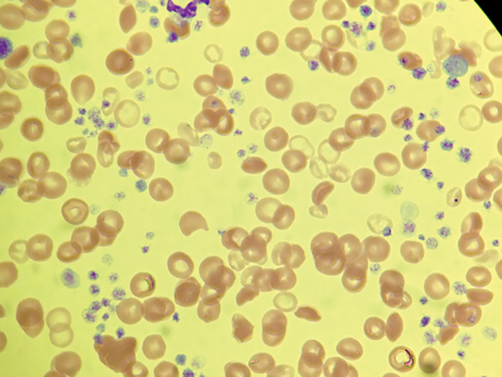 Canine Primary (Idiopathic) Immune-Mediated Thrombocytopenia ...