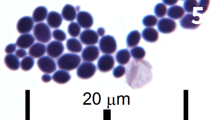 Cytology Challenge: Unusual Sediment Findings | Clinician's Brief