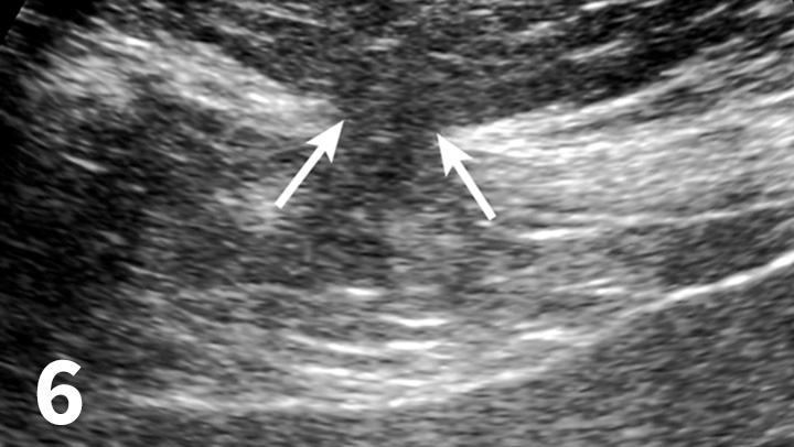 Acute Incisional Hernias | Clinician's Brief